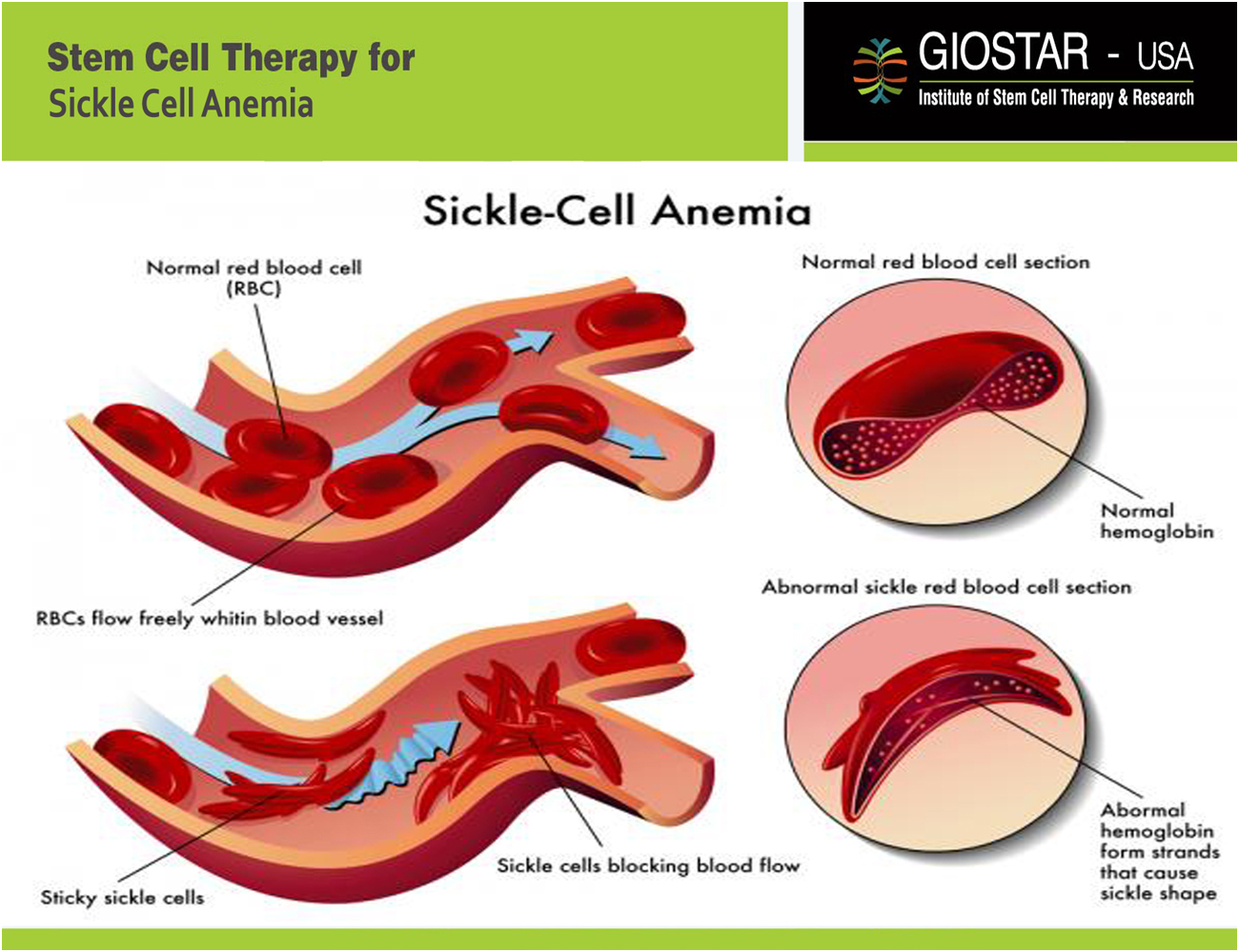 Stem Cell Therapy For Sickle Cell Anemia Treatment For Sickle Cell 