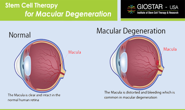 Stem Cell Therapy for Macular Degeneration, Macular Degeneration ...