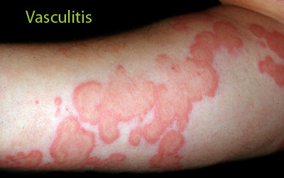 Stem Cell Treatment for Vasculitis in India