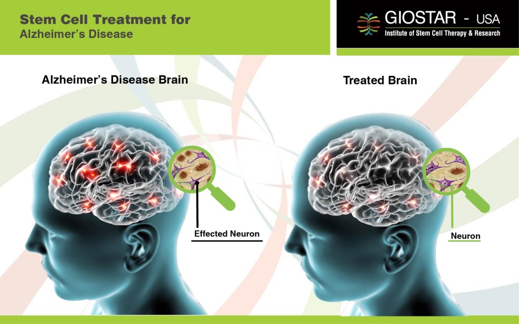 Stem Cell Therapy for Alzheimer in India