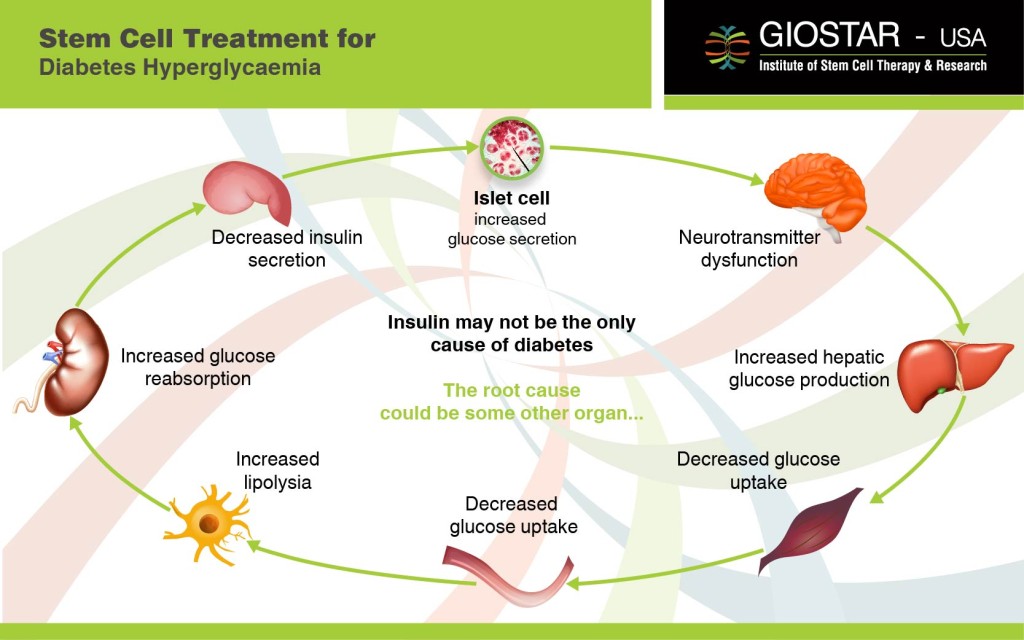 Stem Cell Therapy for Diabetes, Treatment for Diabetes in India