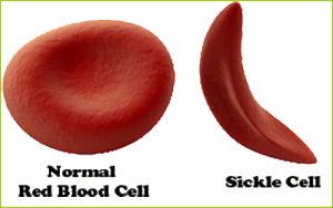 SICKLE CELL ANEMIA TREATMENT - GIOSTAR